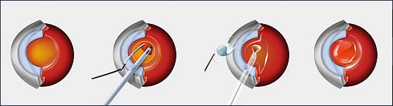 Is Laser-Assisted Cataract Surgery Superior to Traditional Methods ...
