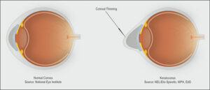 Cornea Omaha | Keratoconus Omaha | Omaha Eye