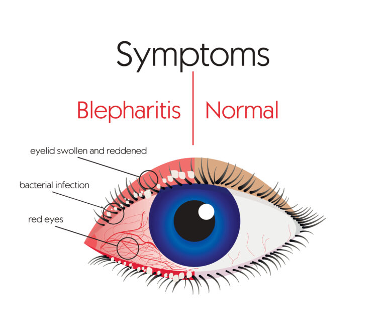 What are My Options When it Comes to Dry Eye Treatment? - Omaha Eye and ...